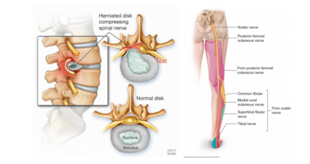 Radiculopathy Treatment Inline Physio Radiculopathy Treatment Inline Physio