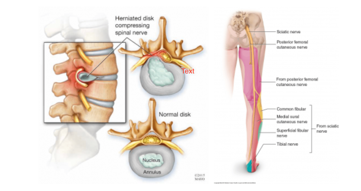 Radiculopathy Treatment Inline Physio 